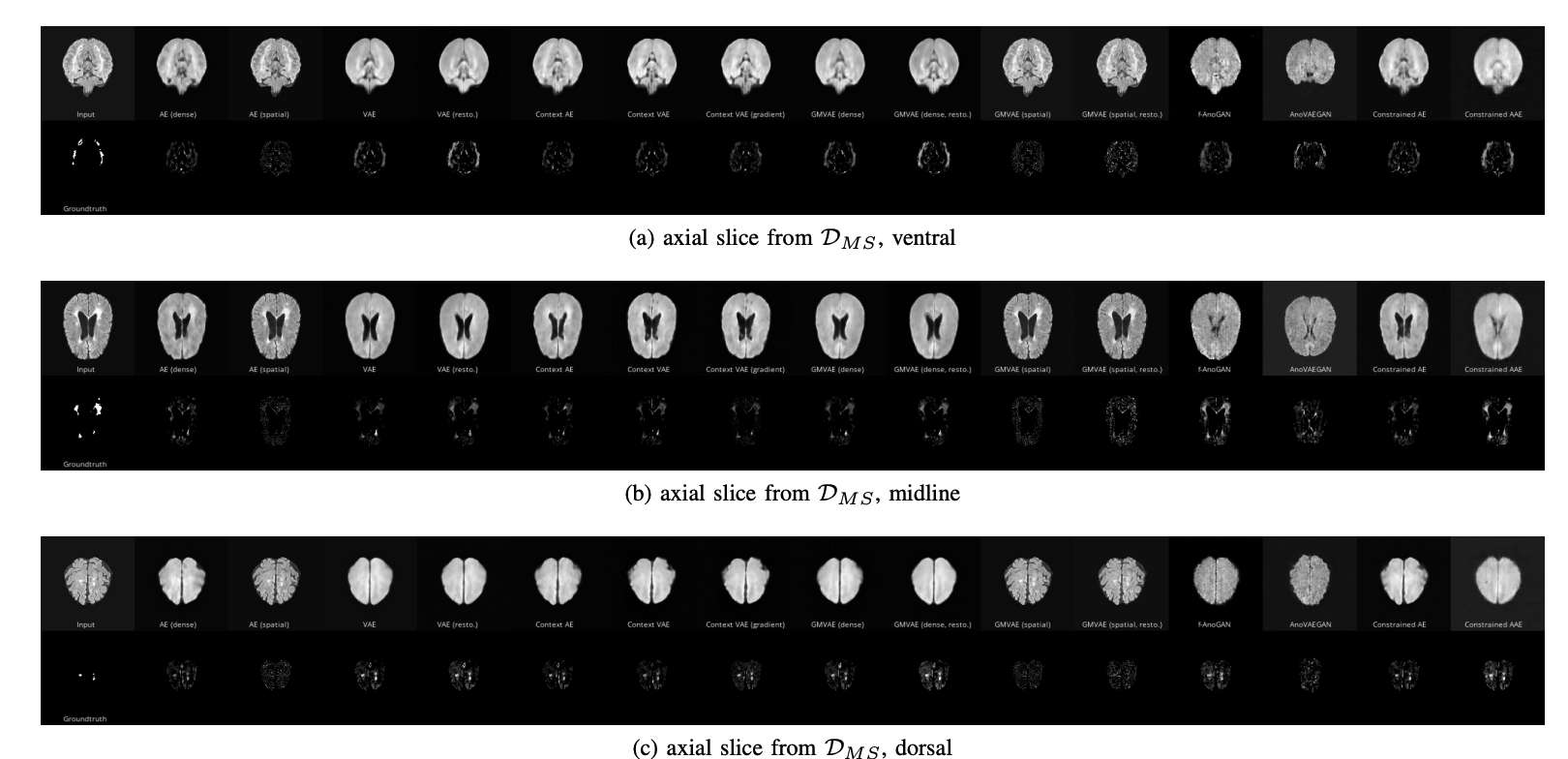 Autoencoders for Unsupervised Anomaly Segmentation in Brain MR Images ...