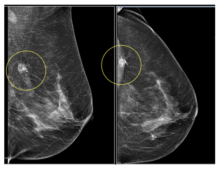 Ma Thesis Investigating Bias In Ai Algorithms For Breast Cancer